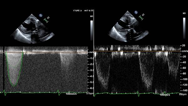 Five-Year Follow-up Reassures on Severe Patient-Prosthesis Mismatch in TAVI | tctmd.com